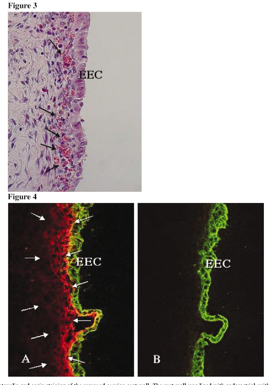 Figure 1 From Acute Elevation Of Plasma D Dimer Levels Associated With