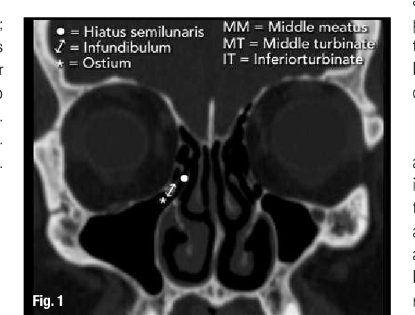 Figure 1 From A Guide To Recognizing Maxillary Sinus Pathology And For