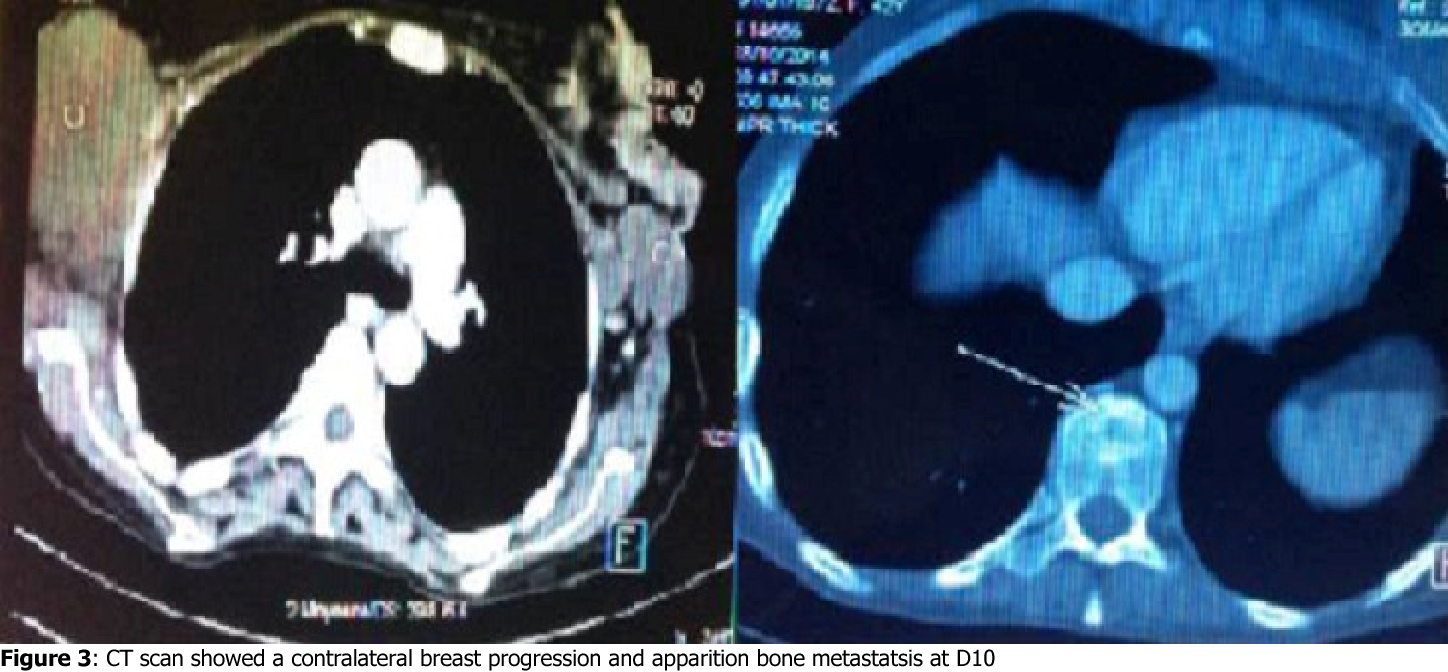 Figure 1 From Primary Squamous Cell Carcinoma Of The Breast A Case