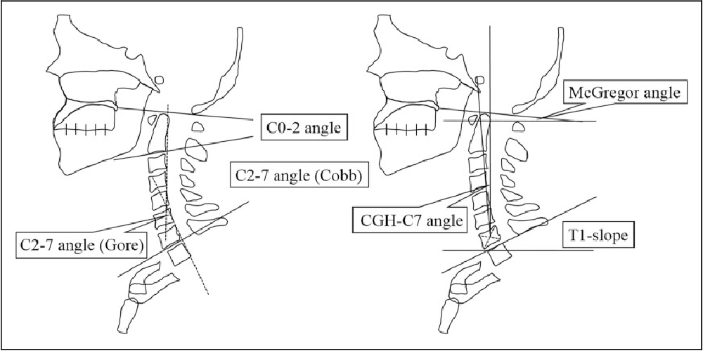 Pdf Evaluating Cervical Sagittal Alignment In Cervical Myelopathy