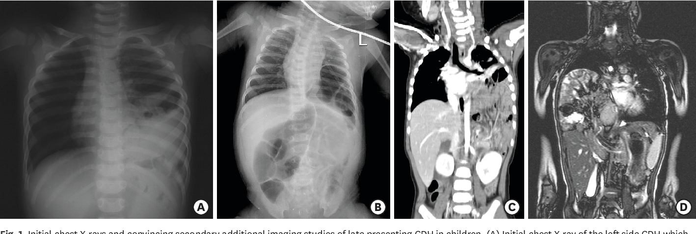 Figure 1 From Diagnostic Considerations Of Late Presenting Congenital