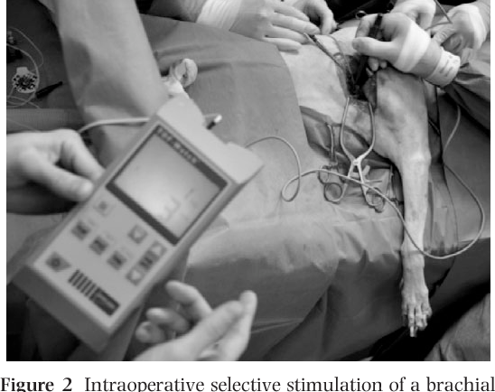 Intraoperative Electrodiagnosis Brachial Plexus