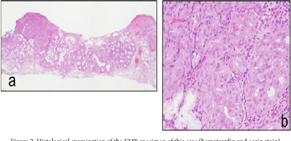 Figure 1 From Gastric Type Adenocarcinoma With Fundic Gland