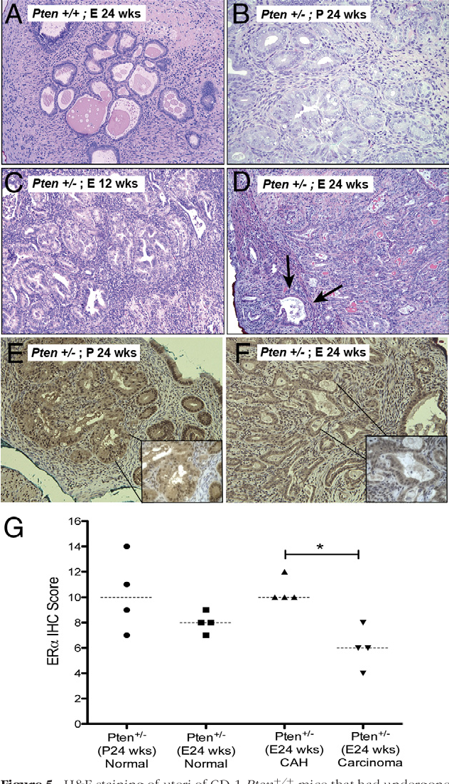 Figure 1 From Tumorigenesis And Neoplastic Progression Endometrial