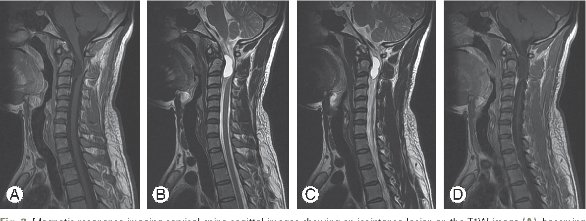 Pdf Cervical Perineural Cyst Masquerading As A Cervical Spinal Tumor