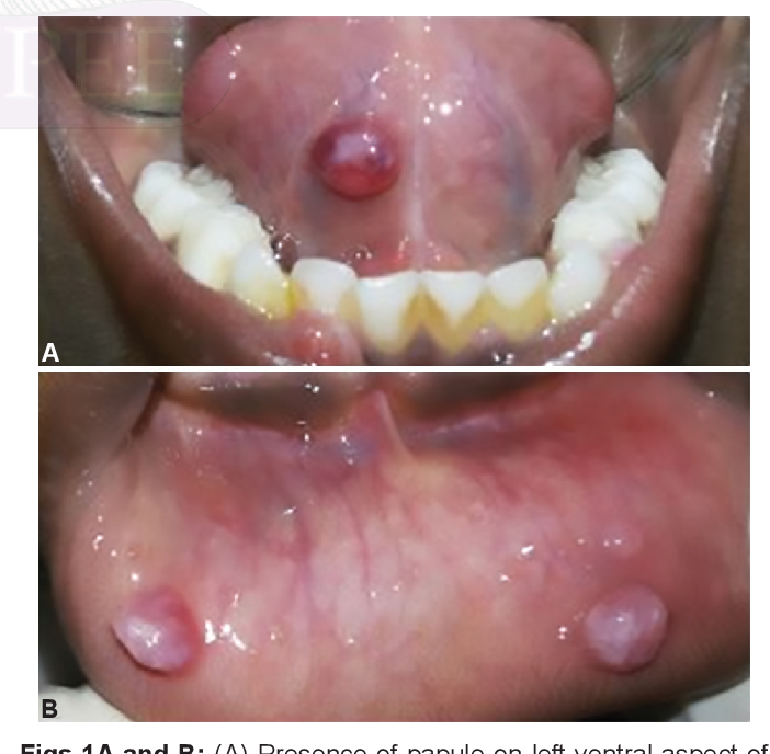 Figure 1 From Laser Excision Of Focal Epithelial Hyperplasia Hecks