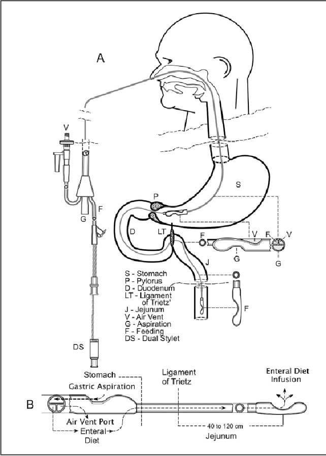 Figure 9 From Dual Purpose Gastric Decompression And Enteral Feeding