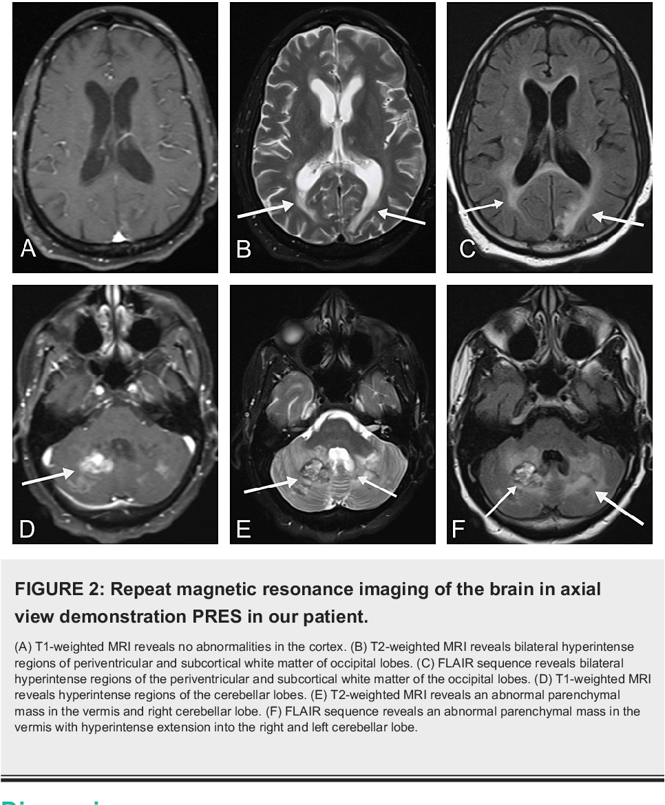 Figure 1 From Posterior Reversible Encephalopathy Syndrome With