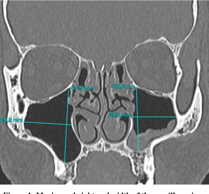 Pdf Validity Of Computed Tomography Maxillary Sinuses Dimensions