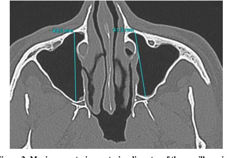 Pdf Validity Of Computed Tomography Maxillary Sinuses Dimensions