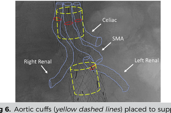 Figure 3 From Techniques Of Antegrade In Situ Laser Fenestration For