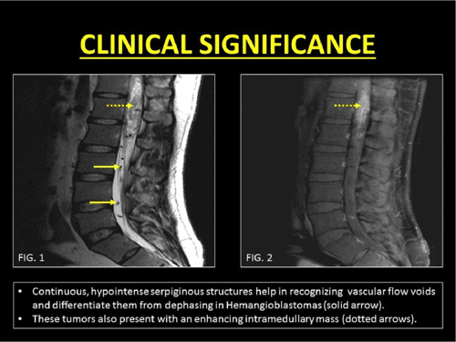 Csf Flow Artifacts In The Spine A Boon Or A Bane Semantic Scholar