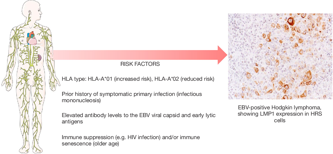 Figure 1 From The Contribution Of Ebv To The Pathogenesis Of Classical