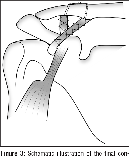 Figure 1 From Anatomical Double Bundle Coracoclavicular Reconstruction