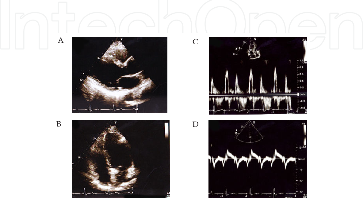 Figure 1 From Echocardiographic Evaluation Of Left Ventricular