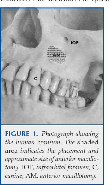 Figure 1 From Endoscopic Sublabial Transmaxillary Approach To The