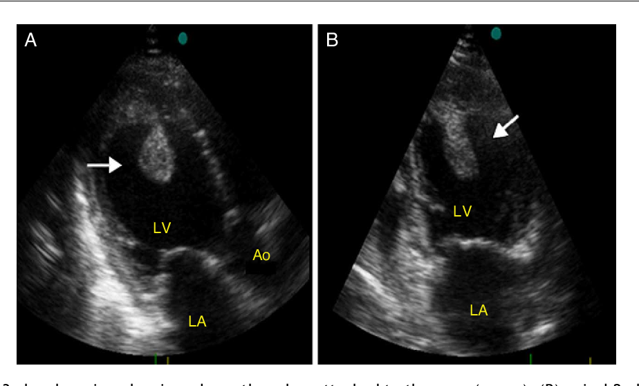 Figure 1 From An Unusual Presentation Of Peripartum Cardiomyopathy