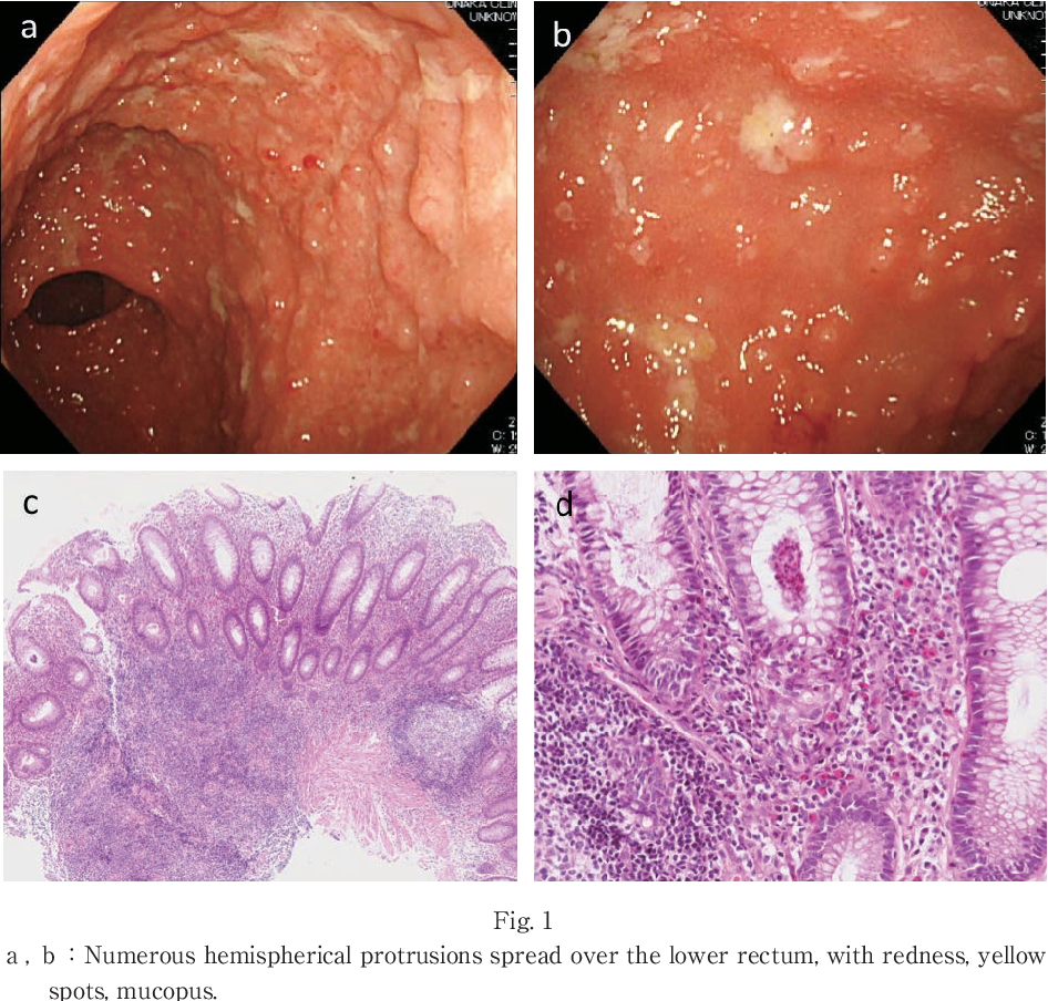 Figure 1 From A Case Of Ulcerative Colitis Mimicking Chlamydia