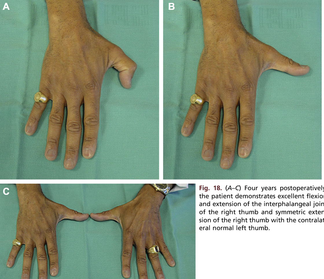 Figure 1 From Tendon Transfers For Radial Median And