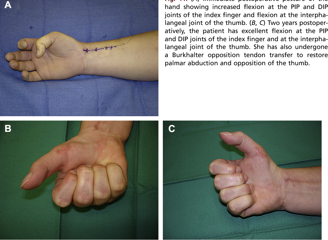 Figure 1 From Tendon Transfers For Radial Median And