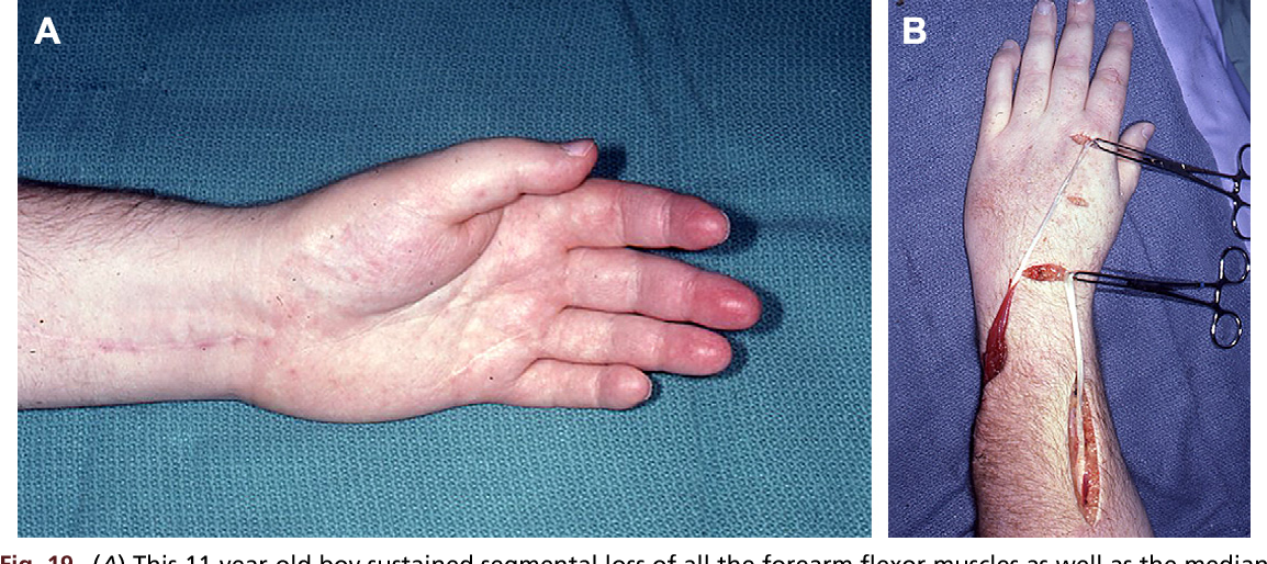 Figure 1 From Tendon Transfers For Radial Median And