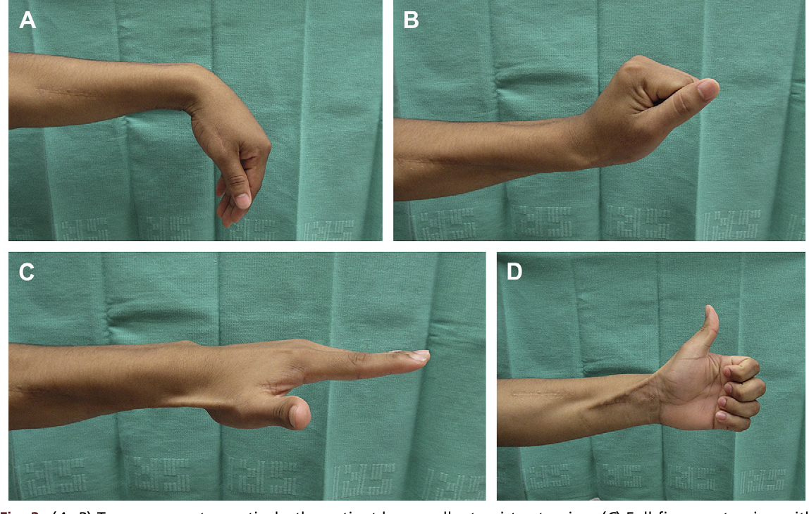 Figure 1 From Tendon Transfers For Radial Median And