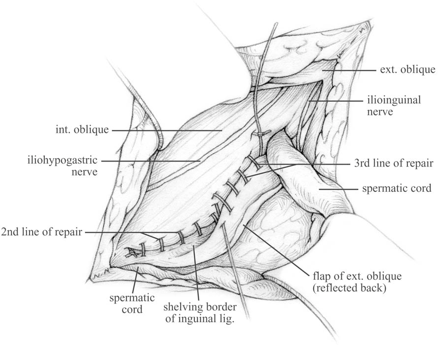 Inguinal Hernia Repair Jama Primary Anatomy