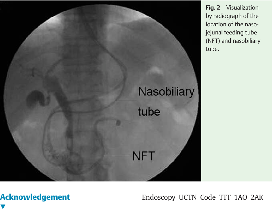 Figure 1 From An Improved Method For Nasojejunal Feeding Tube Placement