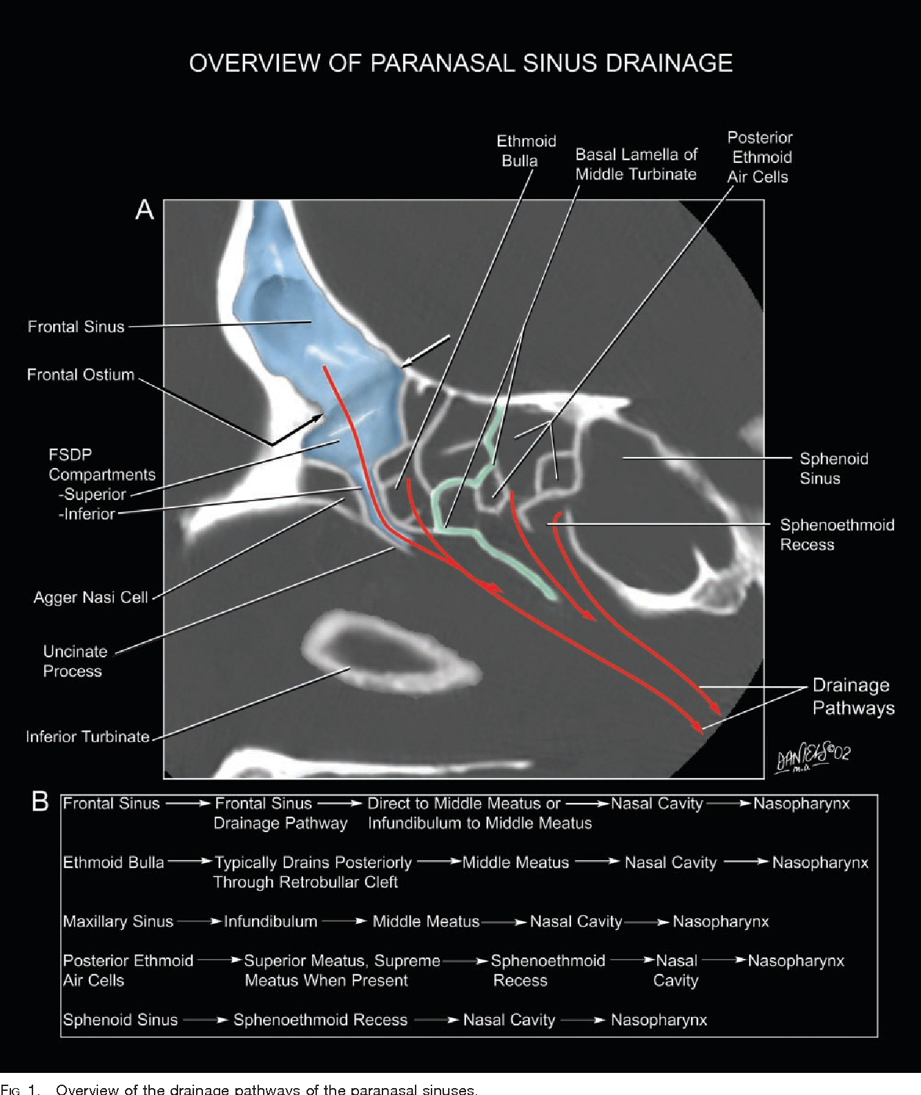 Figure 2 From The Frontal Sinus Drainage Pathway And Related Structures