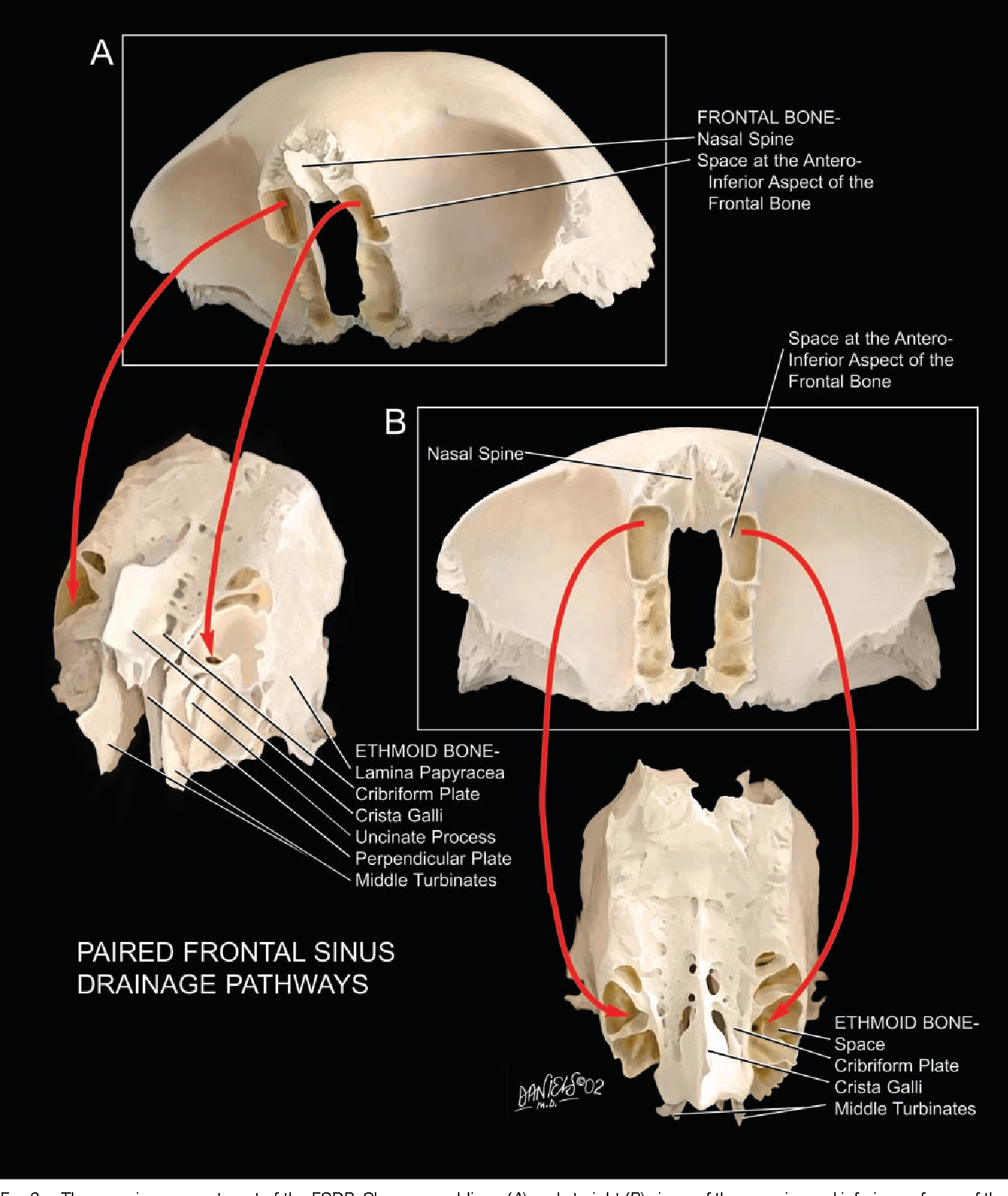 Figure 9 From The Frontal Sinus Drainage Pathway And Related Structures