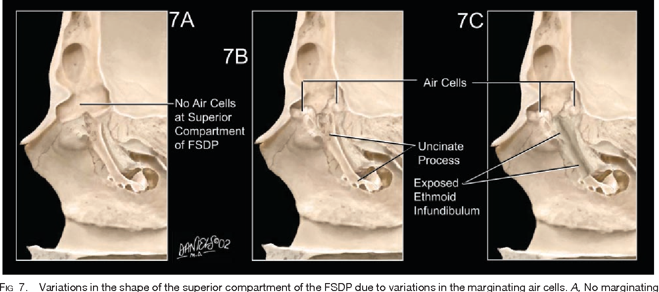 Figure 9 From The Frontal Sinus Drainage Pathway And Related Structures