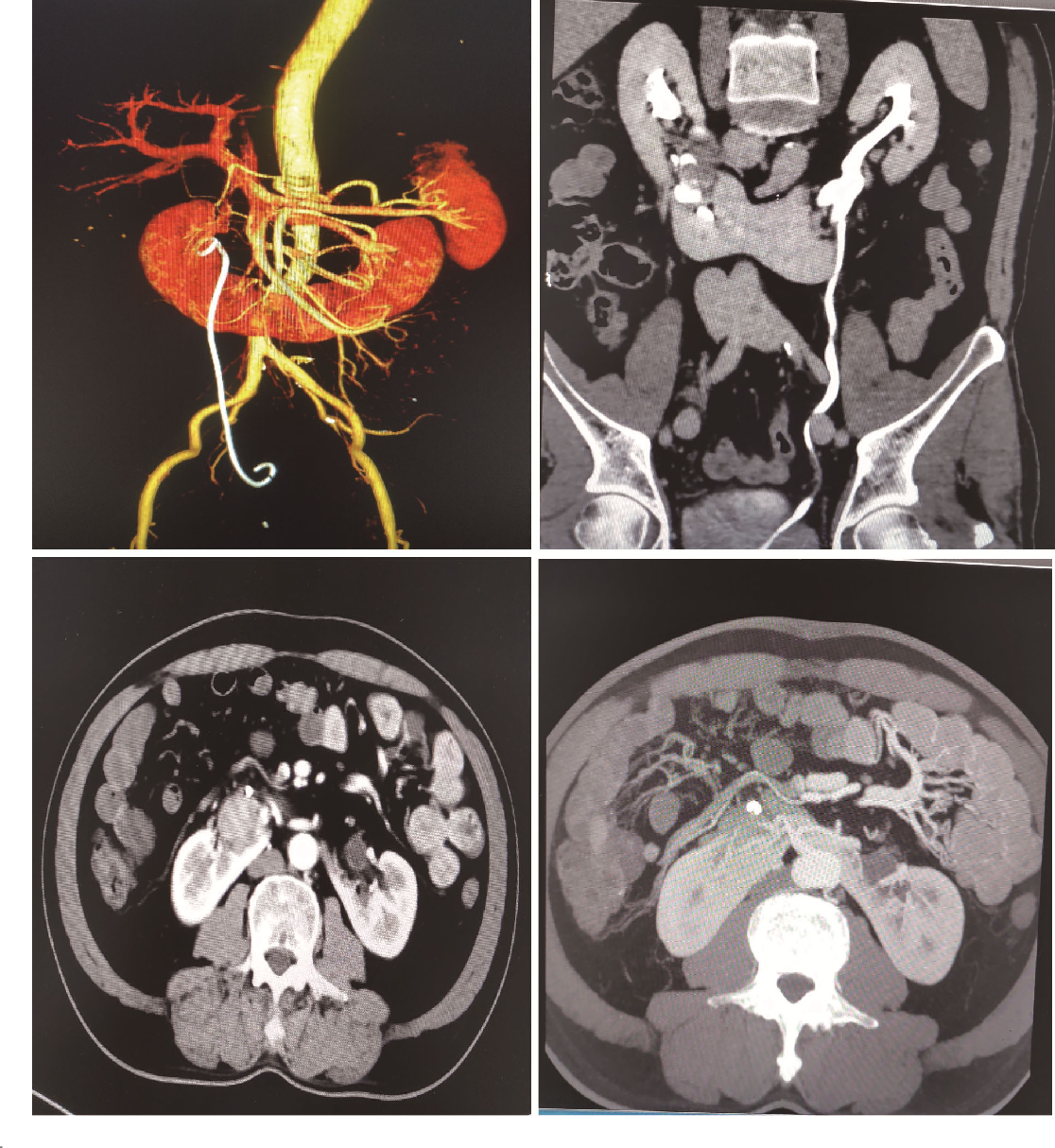 Pure Laparoscopic Radical Nephroureterectomy For Complicated Renal