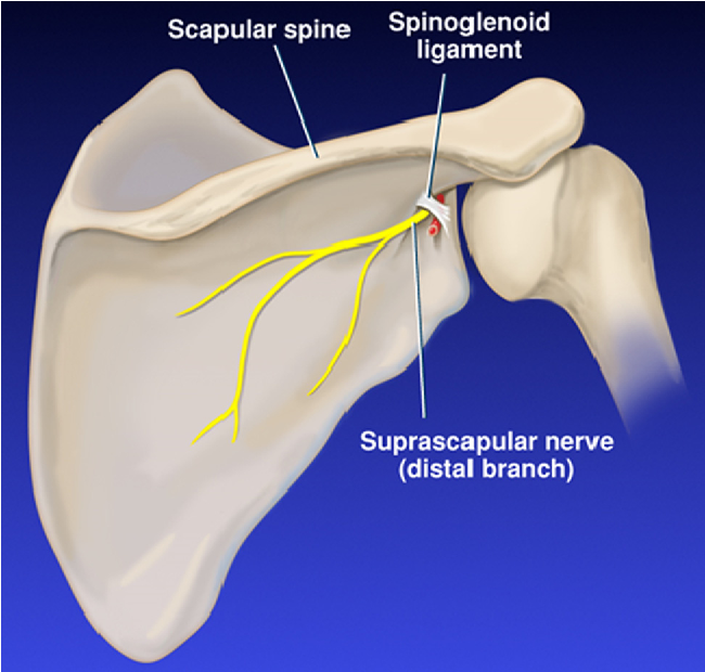 Suprascapular Nerve Entrapment At The Spinoglenoid Notch By A Ganglion
