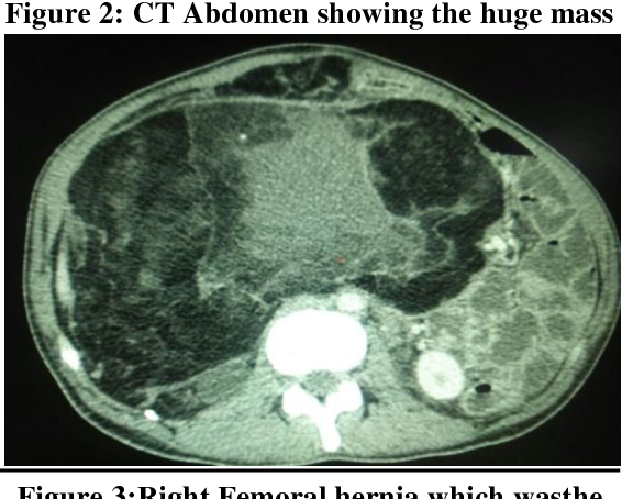 Figure 2 From Retroperitoneal Sarcoma With Femoral And Inguinal