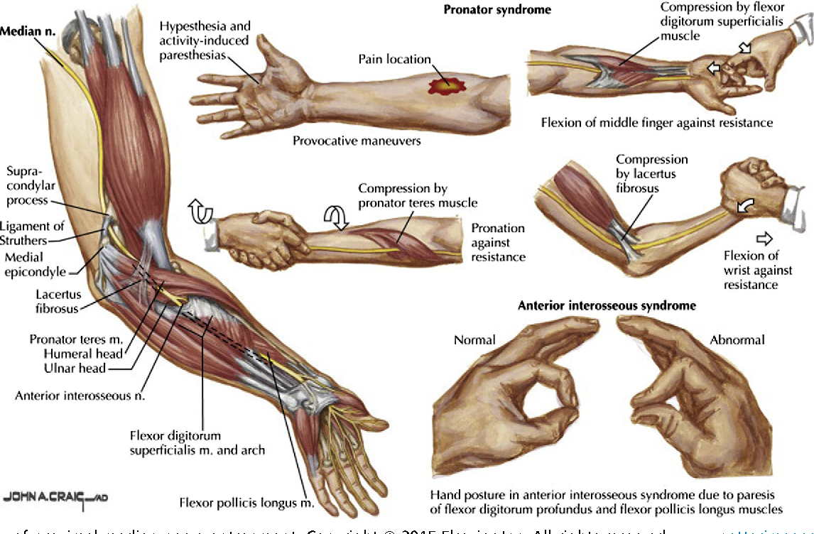 Diagnosis And Treatment Of Work Related Proximal Median And Radial