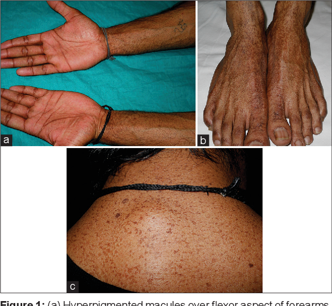 Figure 1 From Dowlingdegos Disease With Reticulate Acropigmentation Of