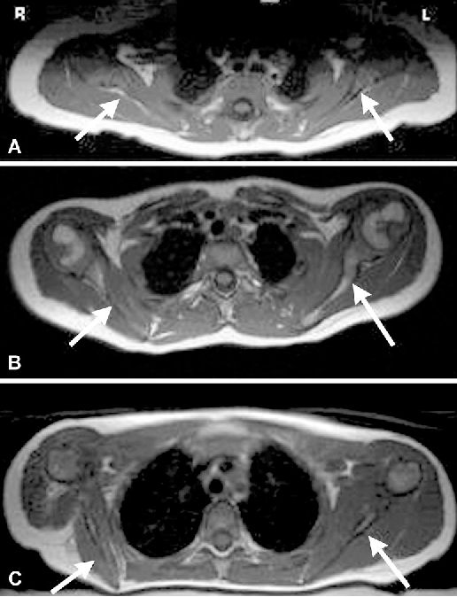 Figure 1 From Accessory Nerve To Suprascapular Nerve Transfer To