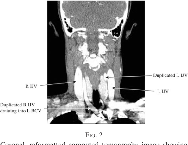 Figure 1 From Duplication Of Internal Jugular Veins Case Report