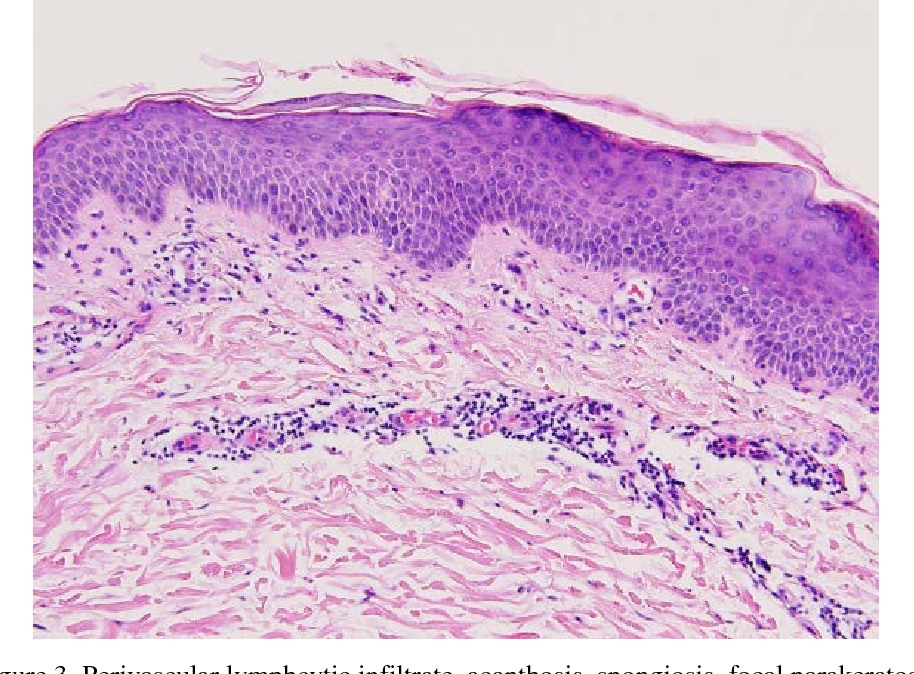 Erythema Annulare Centrifugum Histology