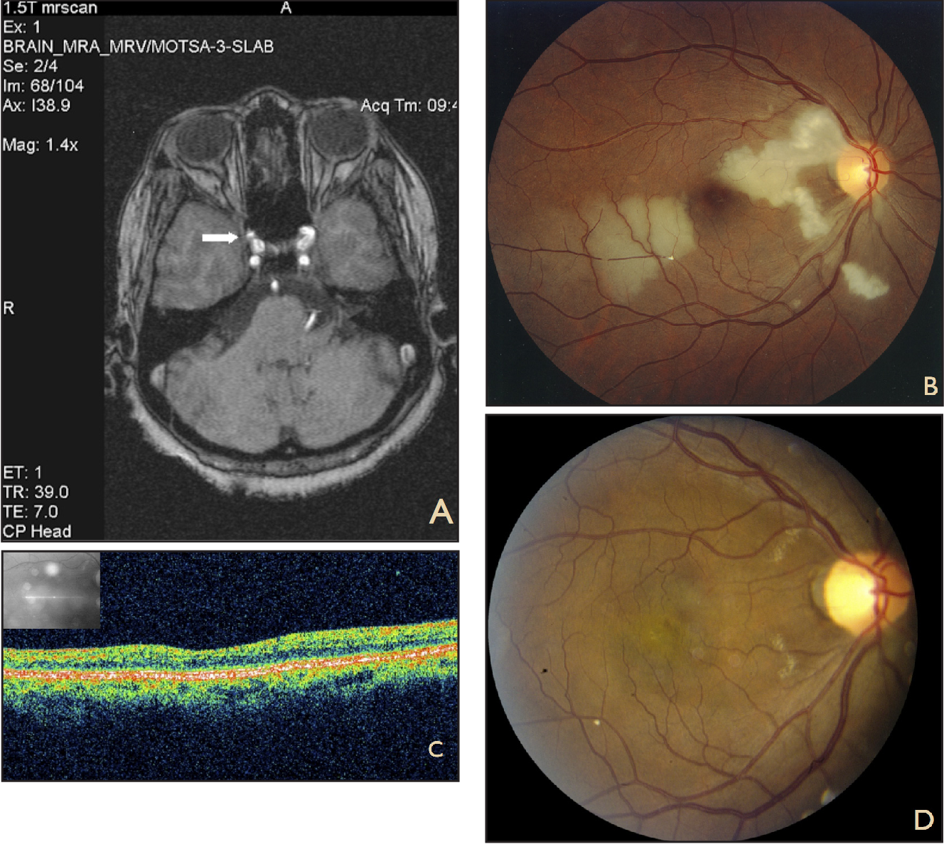 Figure 1 From Branch Retinal Artery Occlusion After Coil Embolization