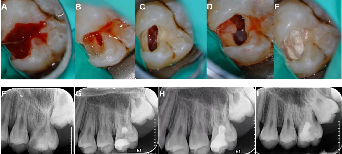 Figure 3 From Vital Pulp Therapy Following Pulpotomy In Immature