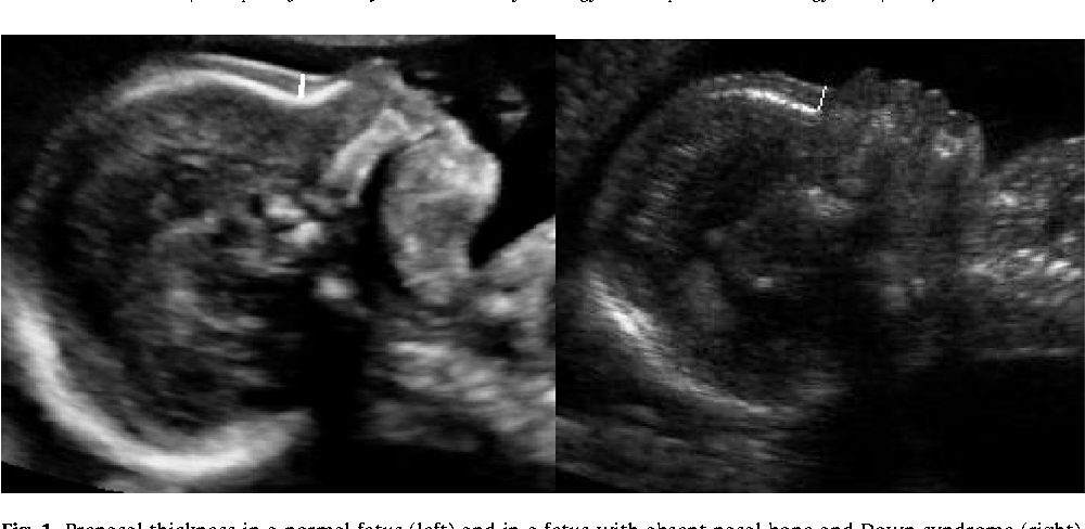 Down Syndrome Ultrasound Markers