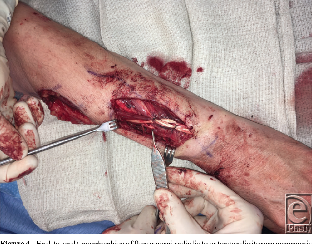 Figure 1 From Extensor Tendon Transfers For Radial Nerve Palsy