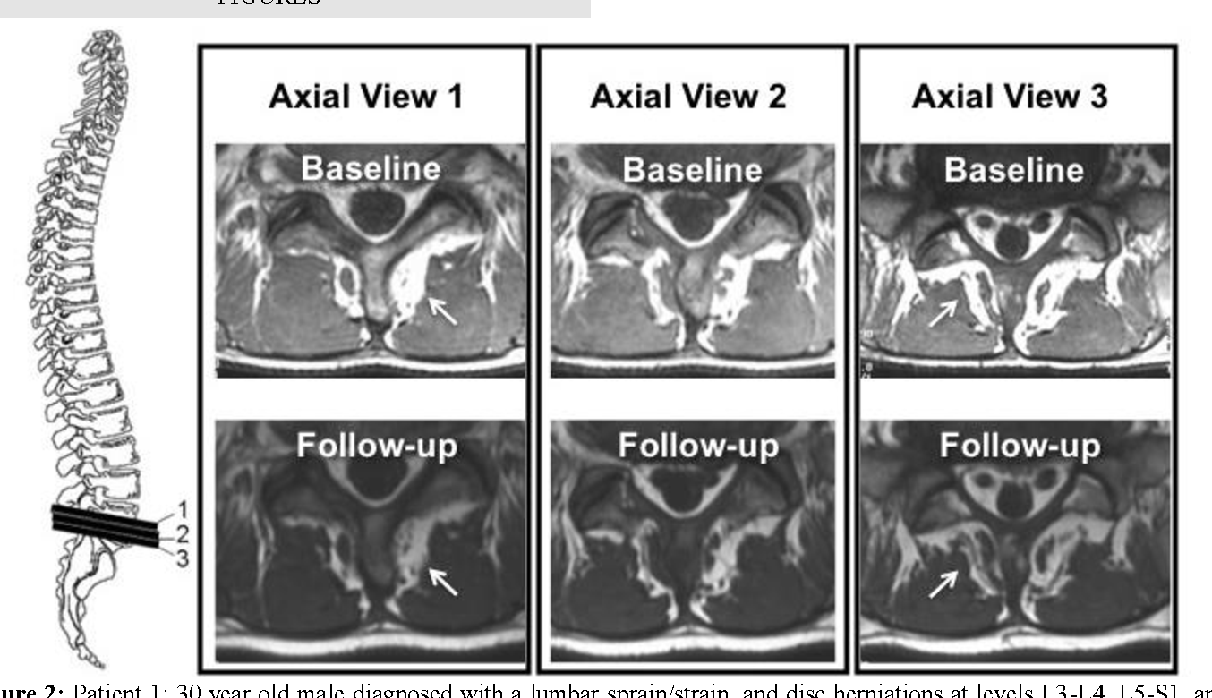 Multifidus Muscle Mri