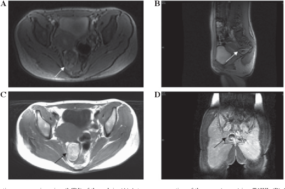 Figure 2 From Identification Of A Mature Cystic Teratoma Mimicking A