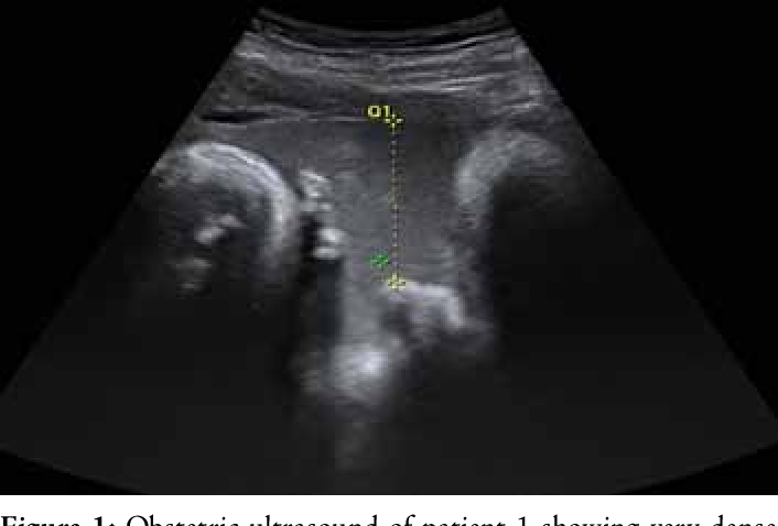 Pdf Review Of Very Echogenic Amniotic Fluid At Term And Its Clinical