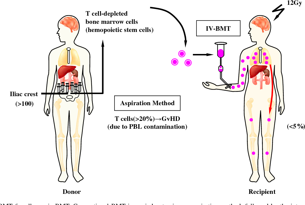 Allogeneic Bone Marrow Transplant