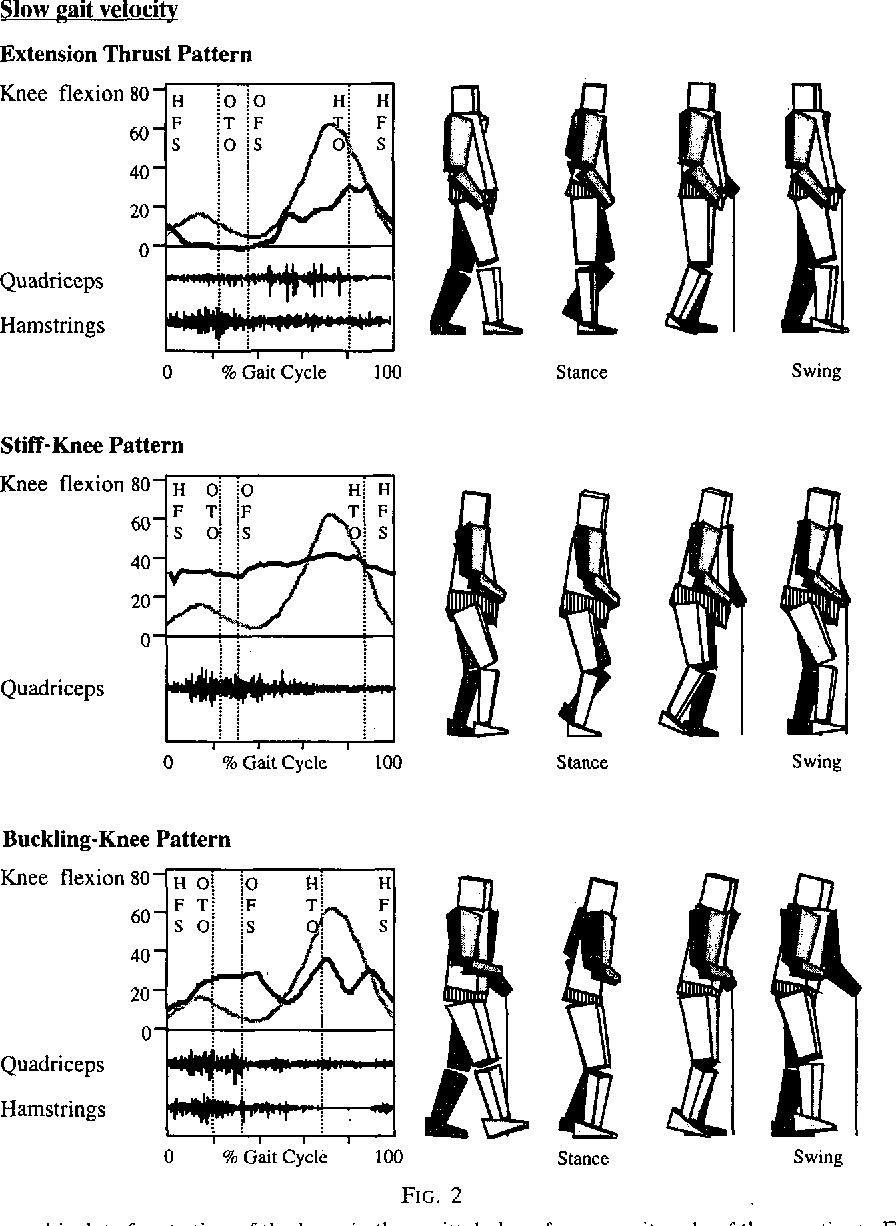 Pdf Gait Pattern In The Early Recovery Period After Stroke