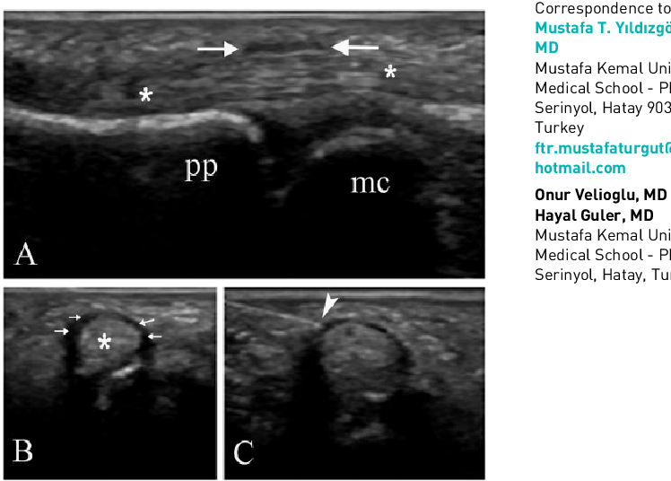 Trigger Finger Ultrasound Guided Injection With An In Plane Approach