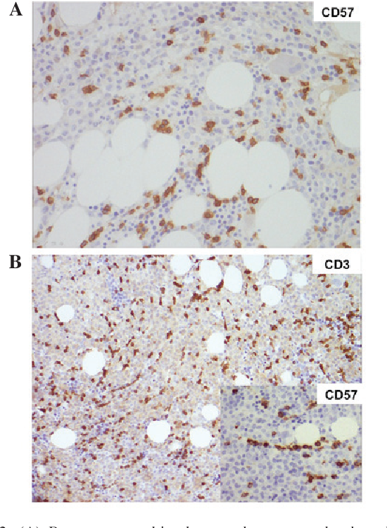 Figure 1 From Multifactorial Neutropenia In A Patient With Acute